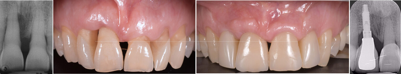 Giovanni Zucchelli in Tallinn: The nightmare of peri-implant papilla