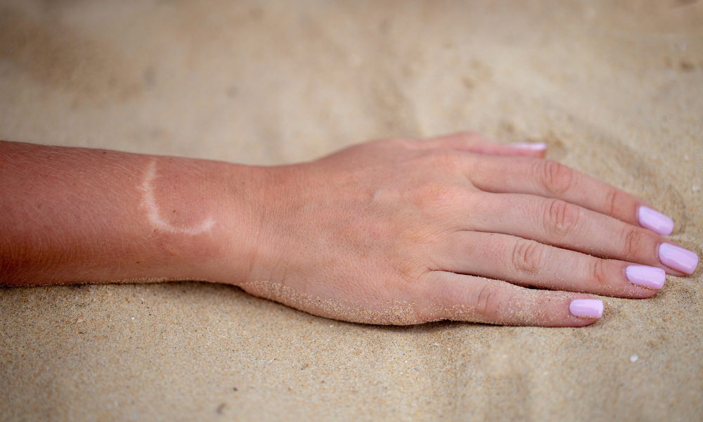 Understanding and Treating Hypopigmented Scars