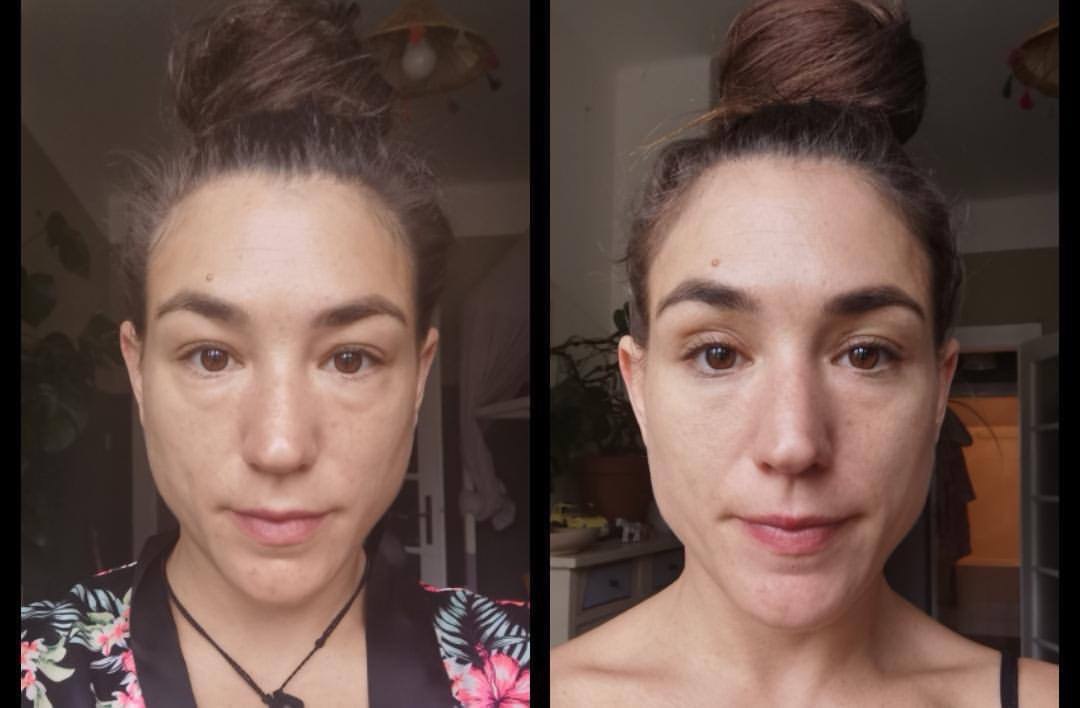 Face Cupping
