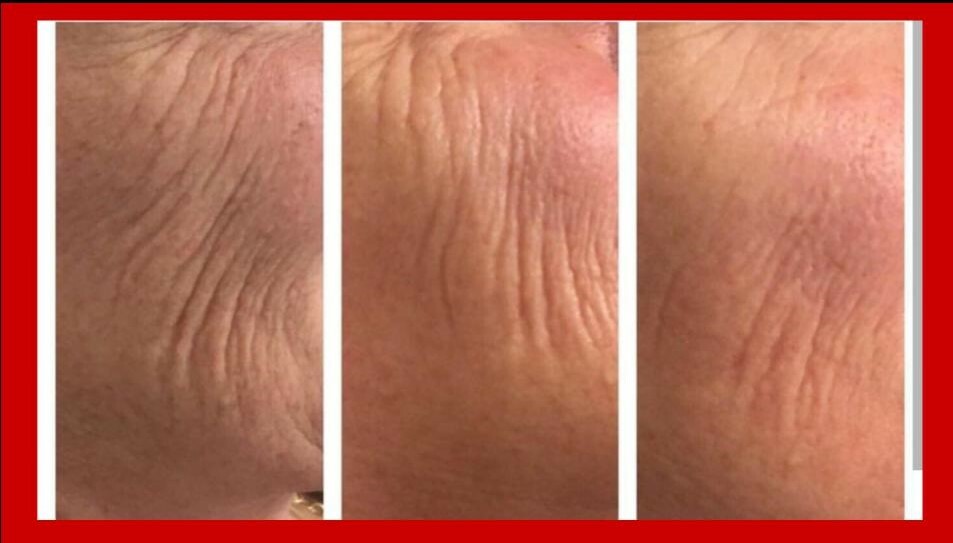 PROFHILO Fantastic Skin Hydration