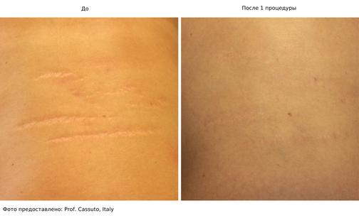 Лечение растяжек на коже на аппарате AirGent