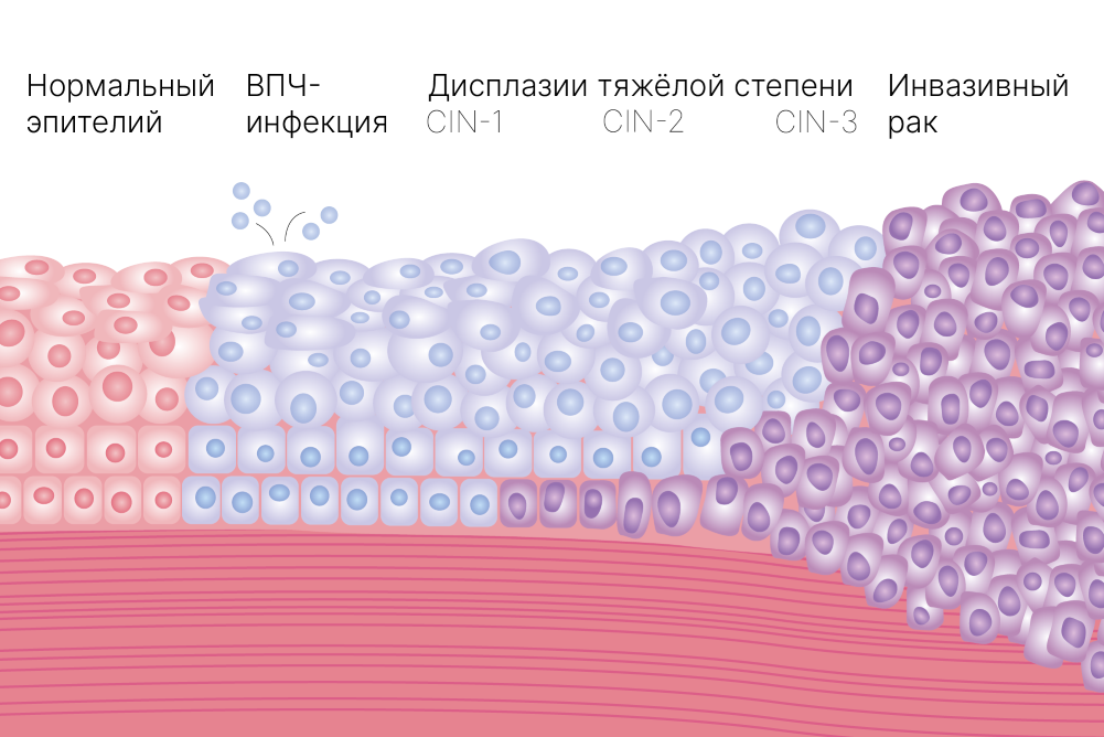 Всё о ВПЧ: защита от вируса