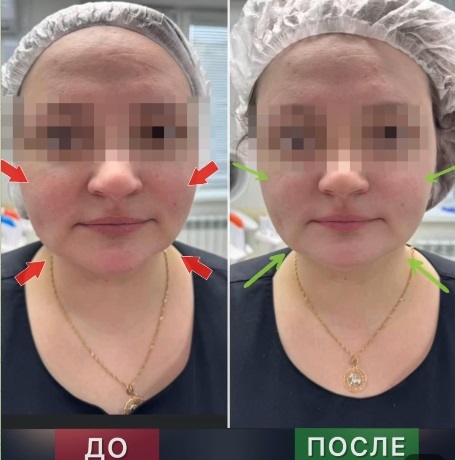 Ультразвуковой SMAS-лифтинг