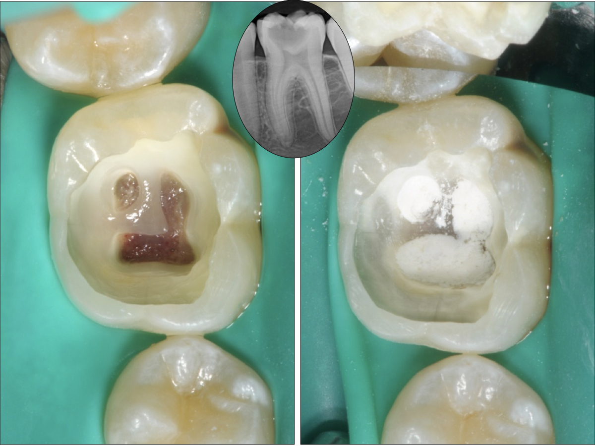 Update in endo 2021 by Domenico Ricucci