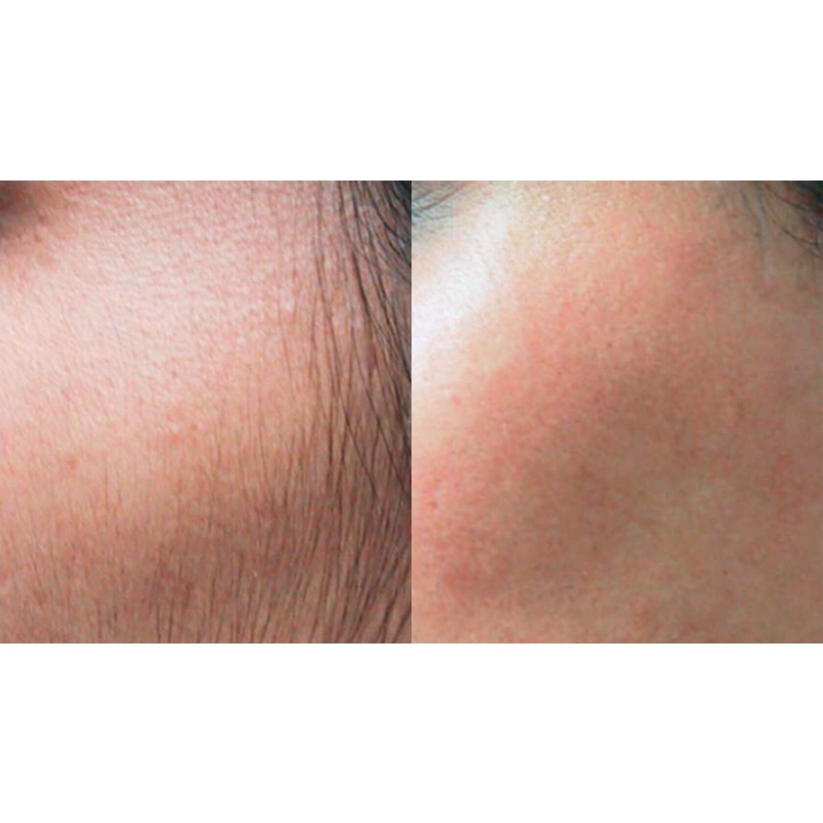 Лазерная эпиляция ᐈ Киев | Candela GentleLase Pro U | Александритовый лазер