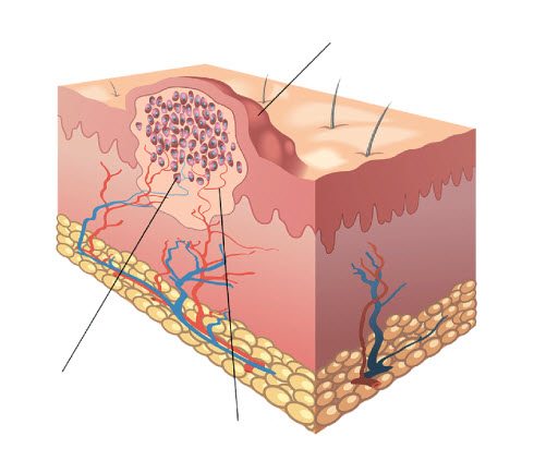 Вартокс® крем-паста от подошвенных бородавок. Официальный сайт