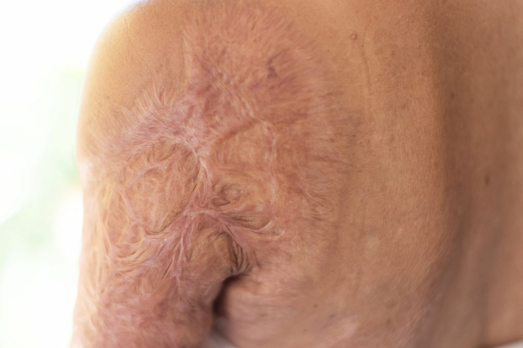 Understanding Scar Maturation: Insights for Effective Management