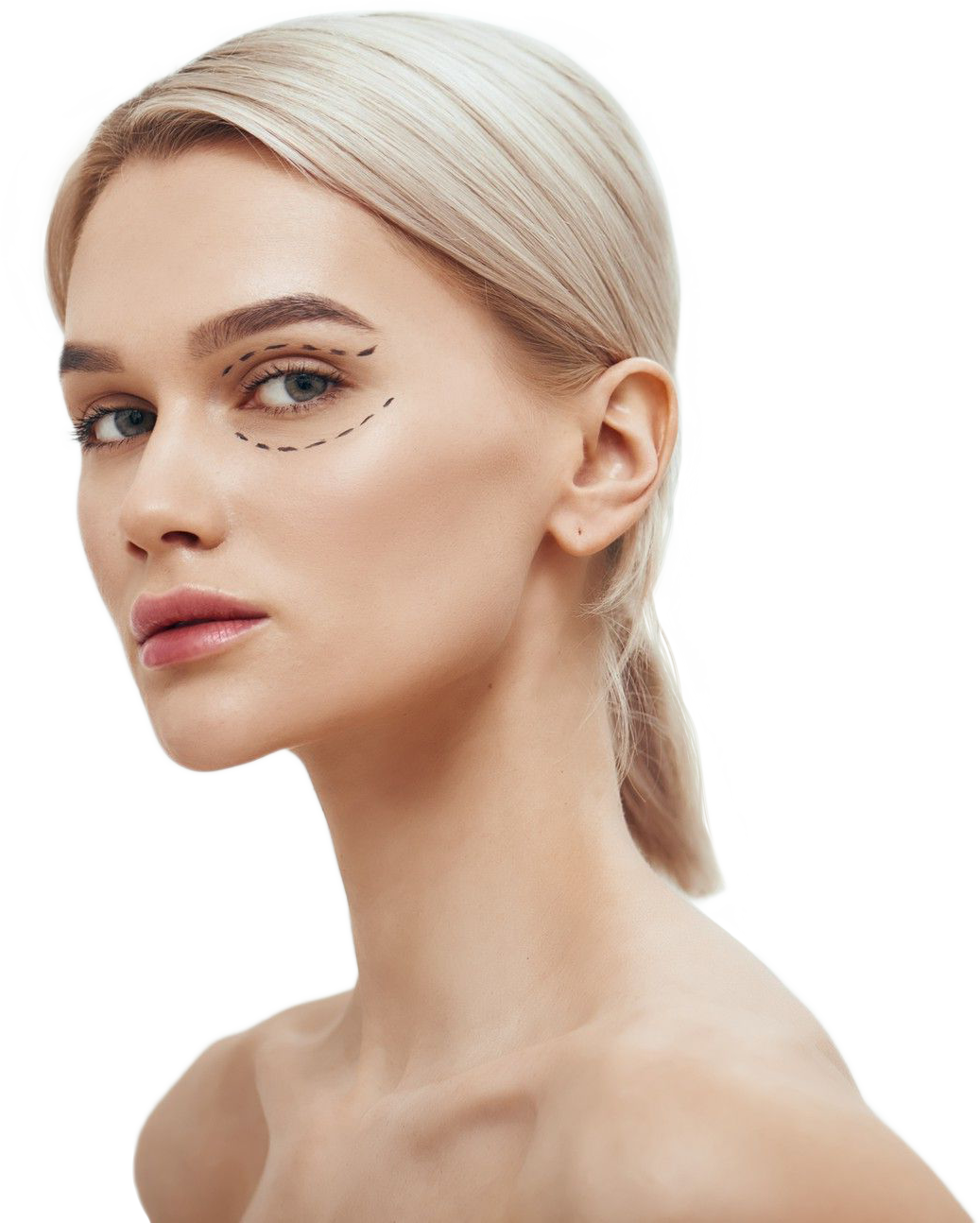 Блефаропластика верхних и нижних век в Москве | Убрать мешки под ...