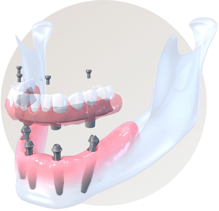 Восстановление при полной адентии запатентованной системой STRAUMANN ...