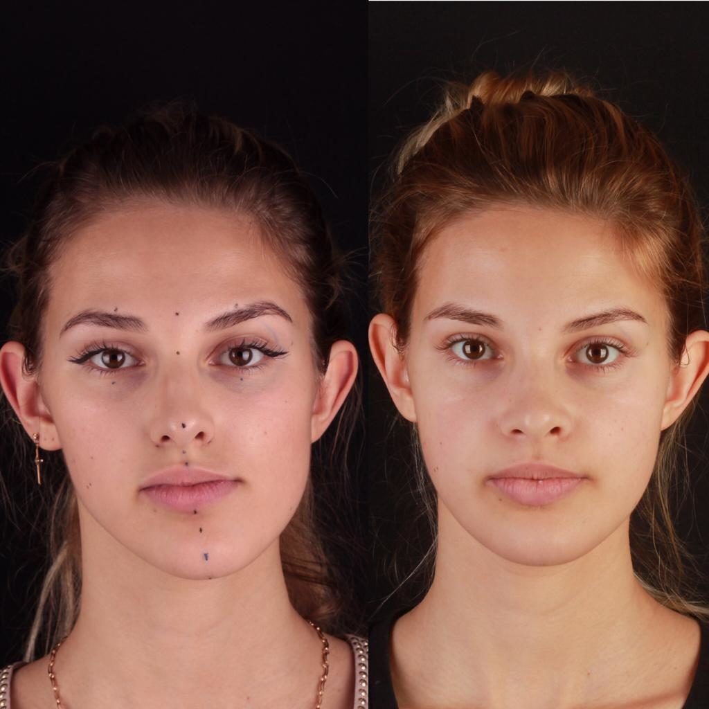 How Braces Change Your Face Shape?