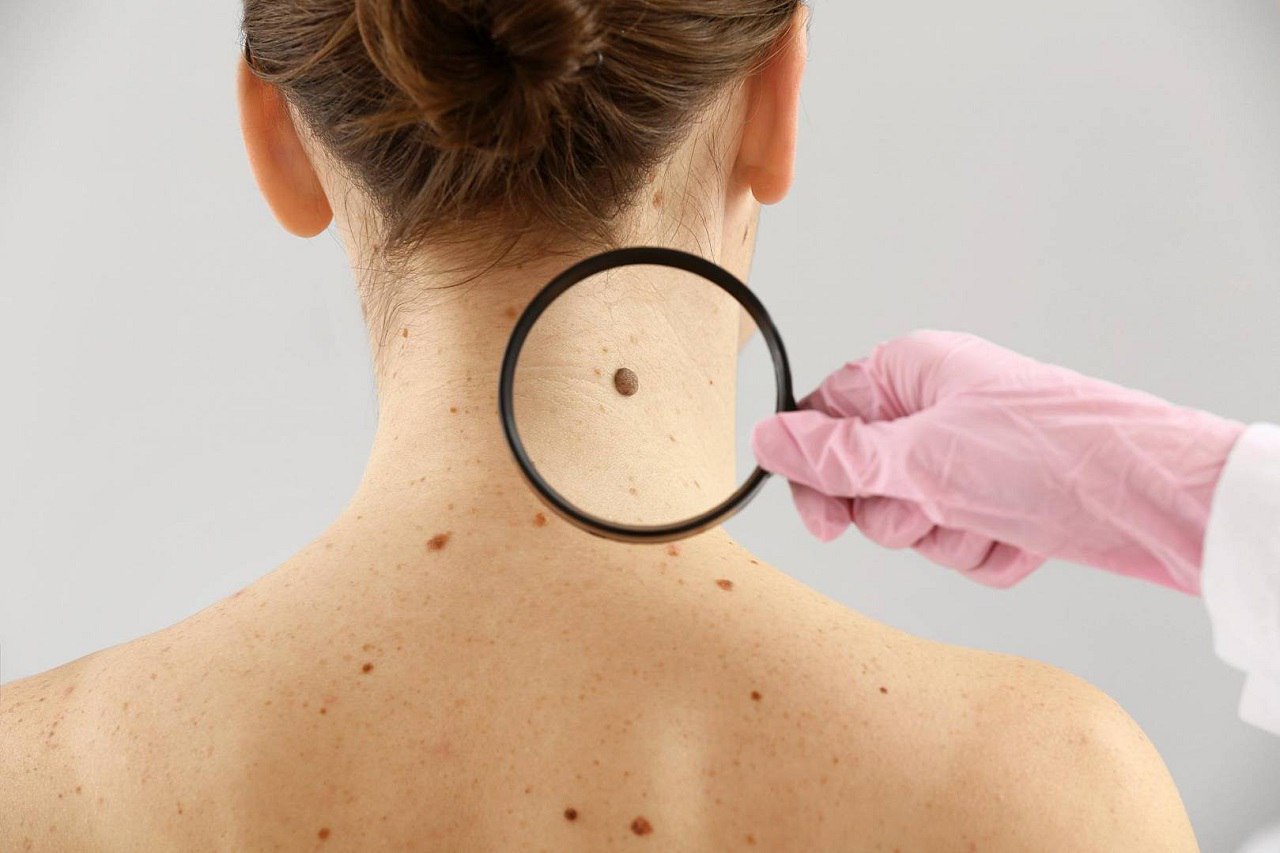 All you need to know about moles