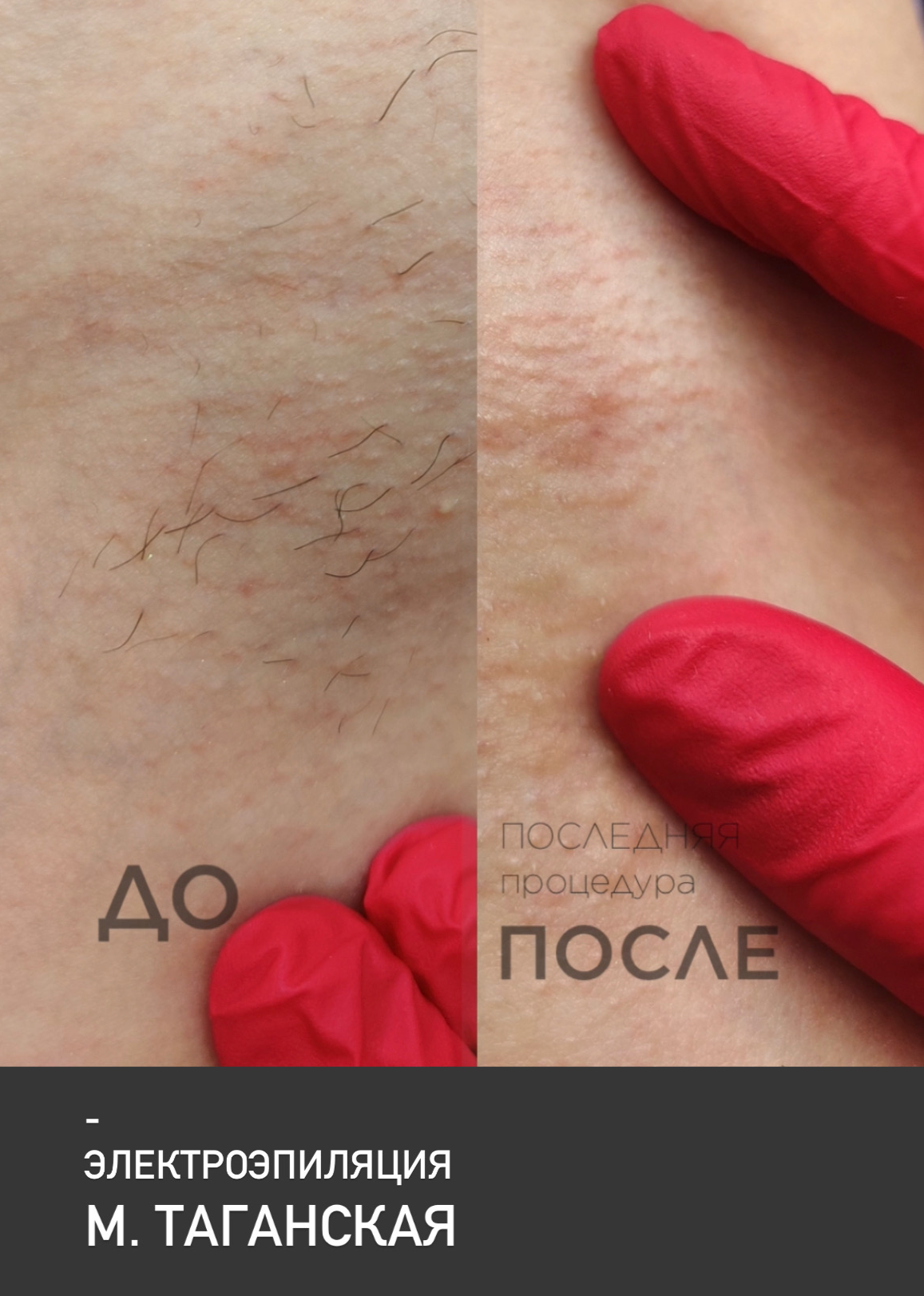 Электроэпиляция в Москве в клинике Effect Epil