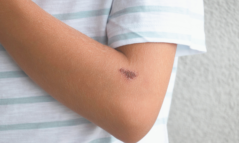 Wound Healing & Scar Formation | Scarless The Clinic