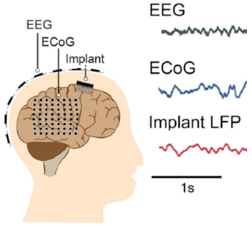 Interfjes između mozga i računara, da li je to rešenje za čoveka da ...
